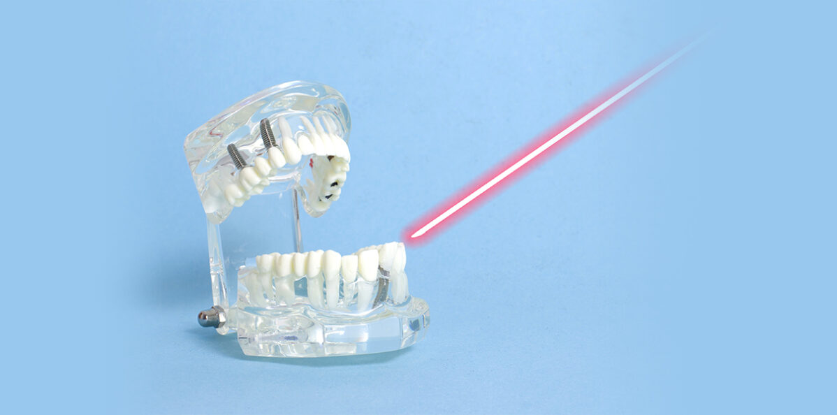 Benefits of Using a Laser for A Frenectomy - Hudson Family Dental
